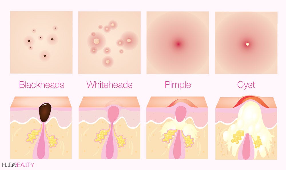 How to Properly Extract Pimples. Having pimples on your face or body ...