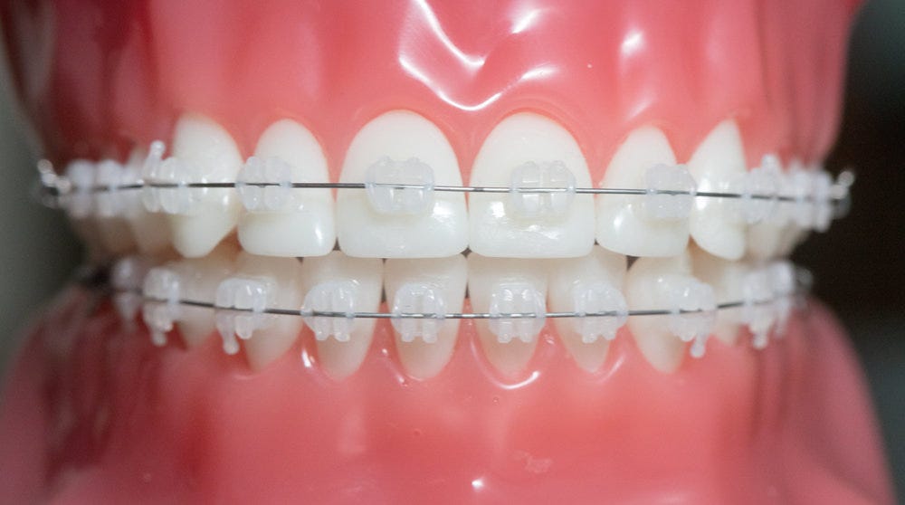 Clarity Braces in Camp Hill. Orthodontic treatment has come a long ...