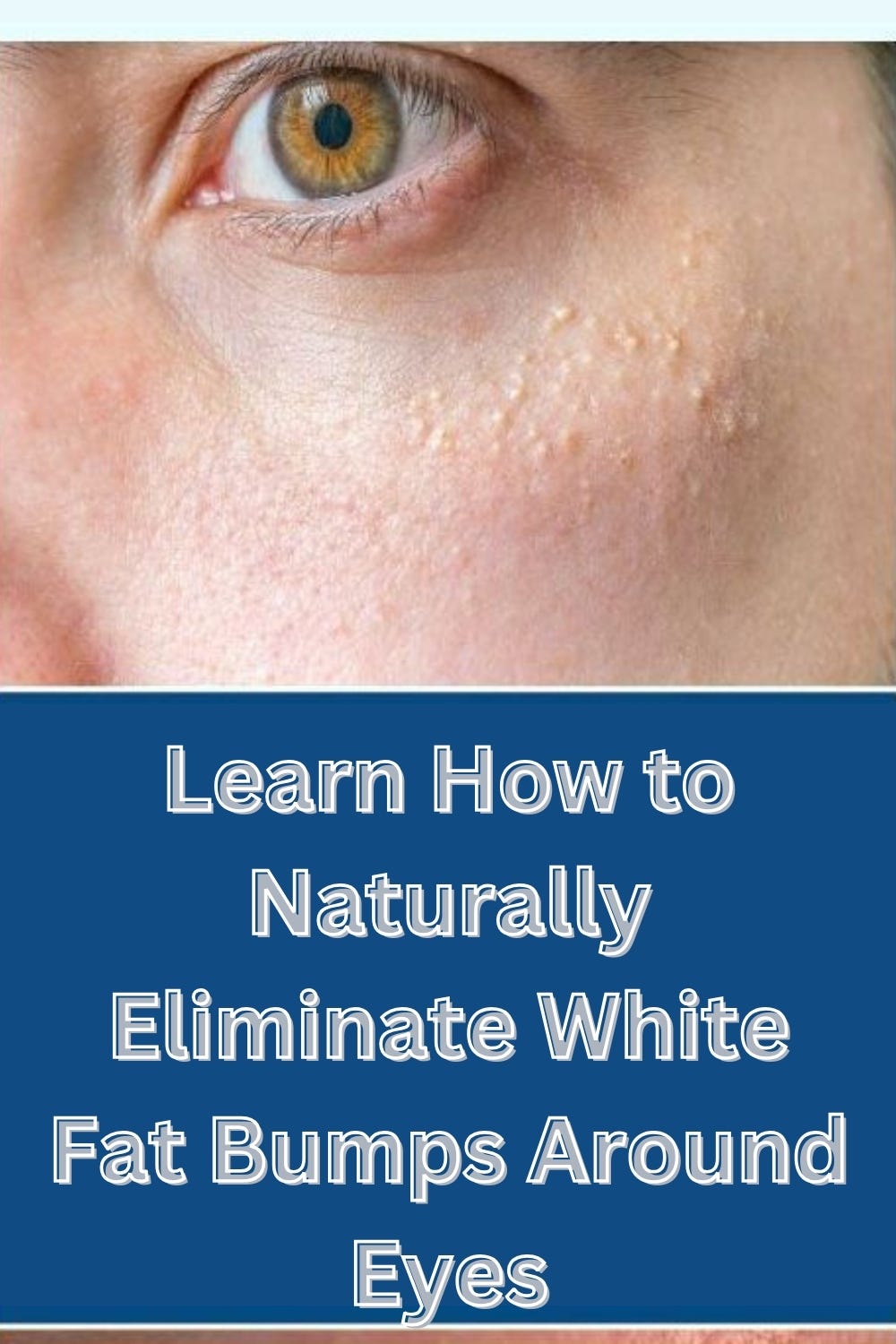 How To Get Rid of White Fat Bumps Around Eyes Naturally - Victoriakeat ...