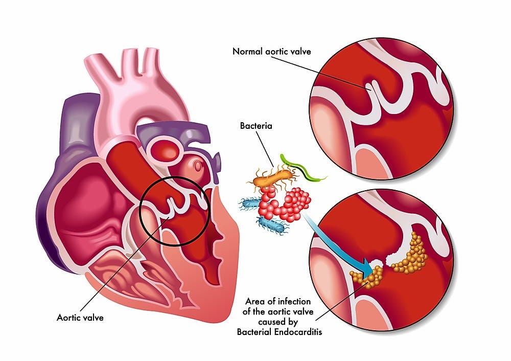 Have you heard of the deadly bacterial infection that specifically ...