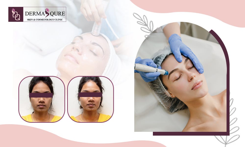 Why Choose HydraFacial in Bangalore: A Short Guide | by Dermaqure ...