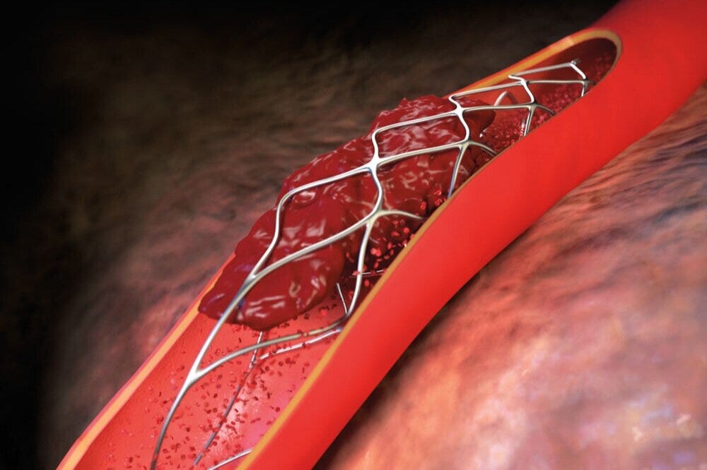 Global Lung Stent Market Estimated to Witness Growth due to Rising ...
