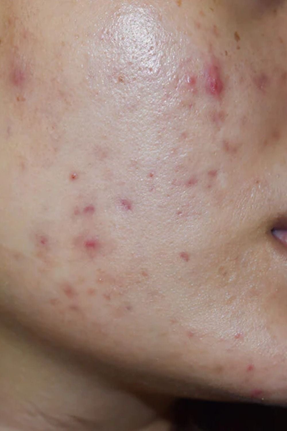 A Skin Story. I have some imperfections, but the one… | by Aanuoluwani ...