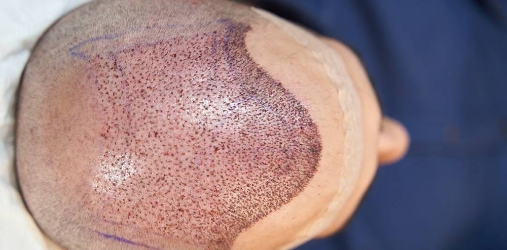 Dealing With Infection After Hair Transplant | by Estevitalya Hair ...