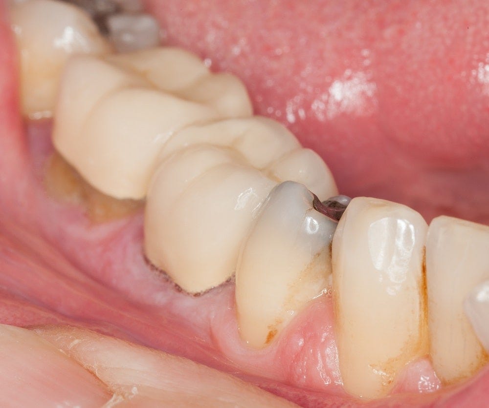 How to reverse Cavities and Tooth Decay by this mixture ...