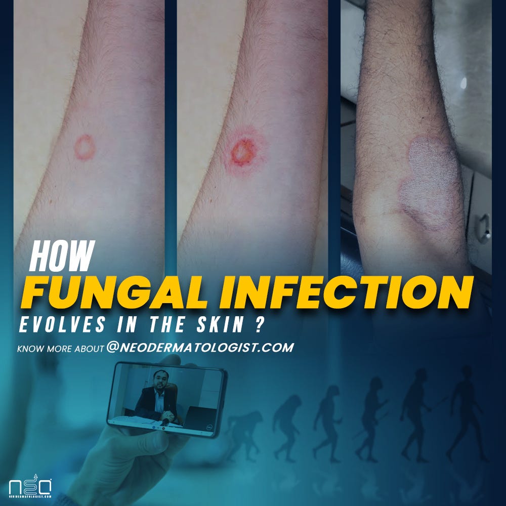 premier fungal infection doctor - neodermatologist - Medium