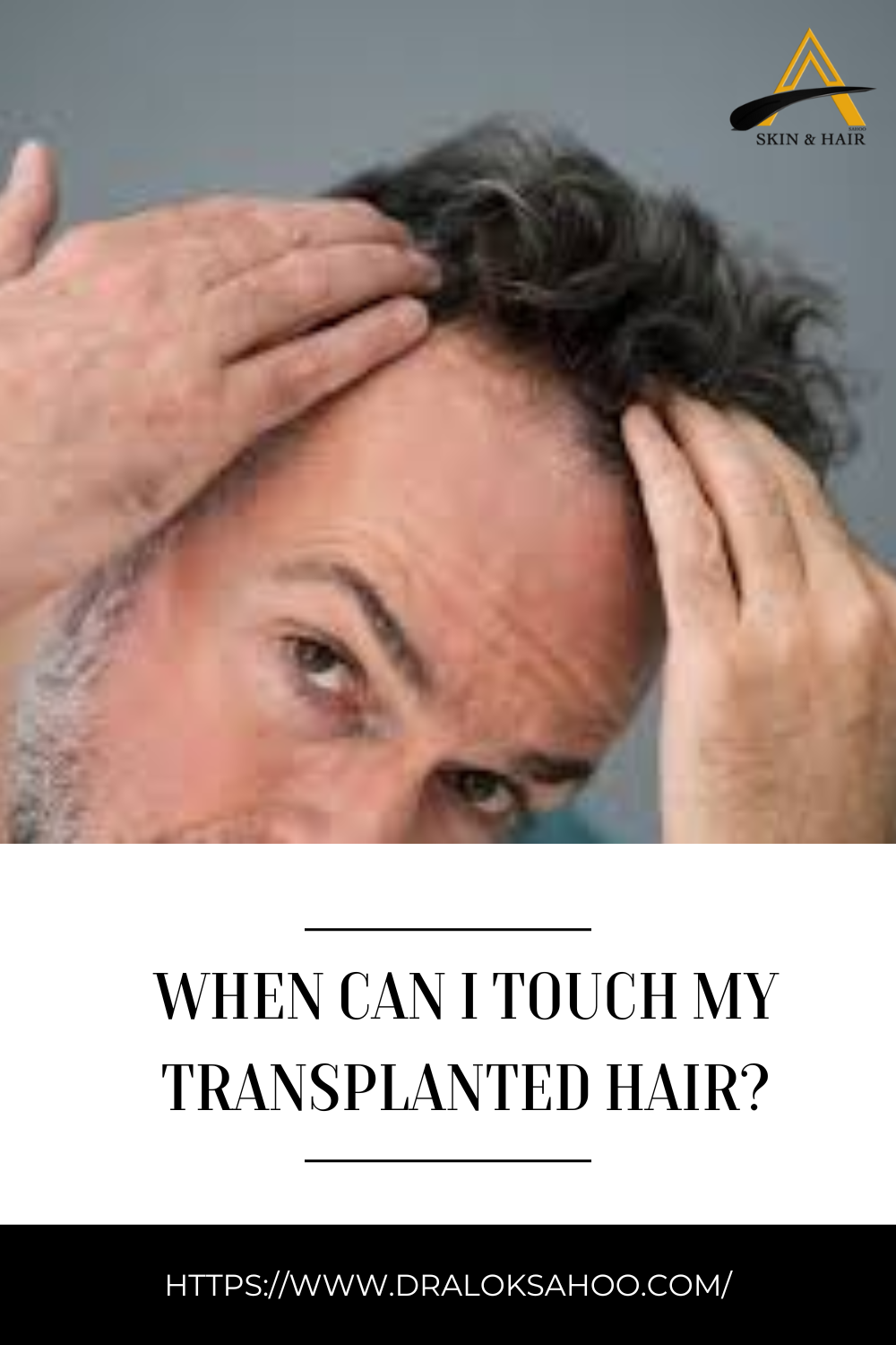 When can I touch my transplanted hair? — Dr Alok Sahoo - Dr Alok Sahoo ...
