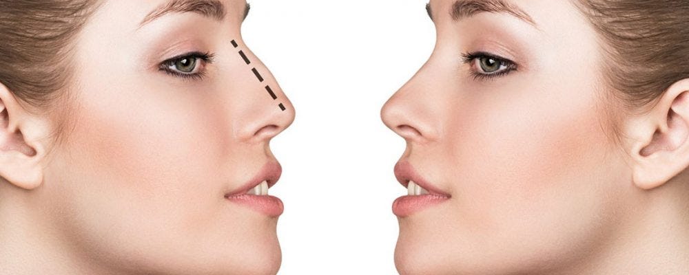 Burun Estetiğinden Sonra Burunda Çökme Olur Mu? | by Dr Suleyman TAS ...