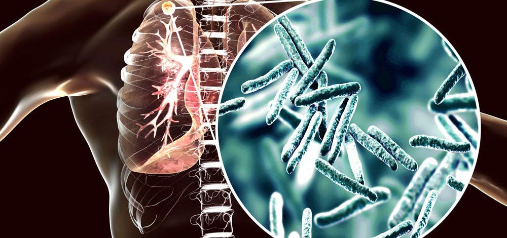 Can CRISPR-Based Diagnostics End The Battle Against Tuberculosis? | by ...