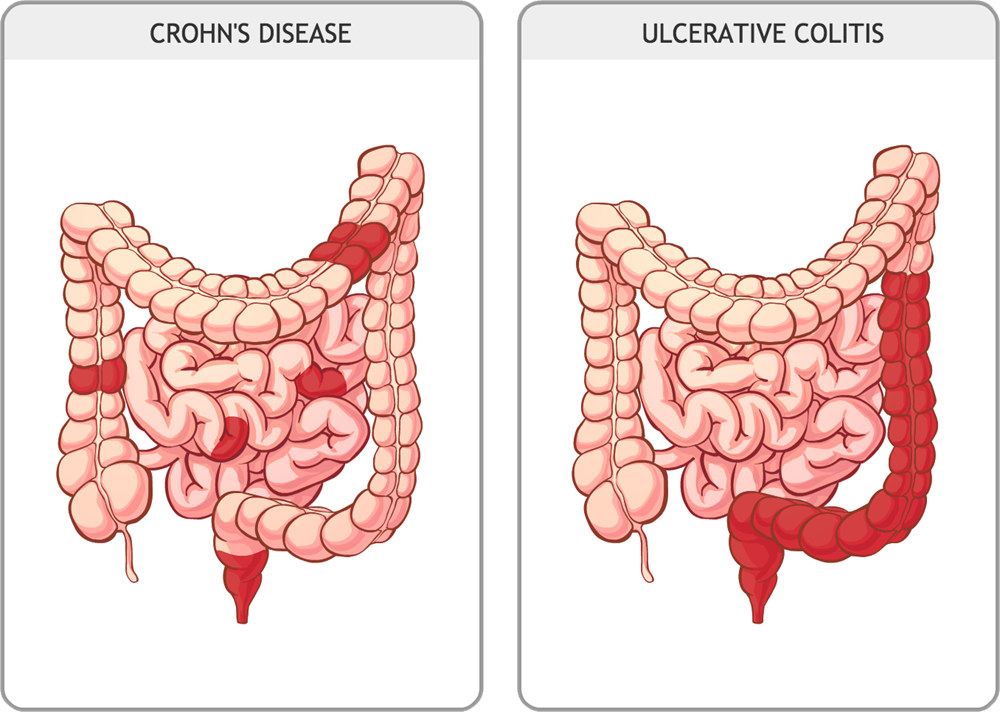 Natural Treatments for Ulcerative Colitis - Victor Țan - Medium