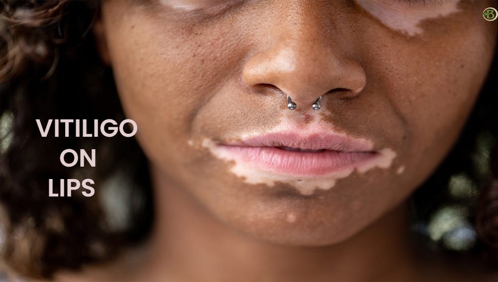 Understanding and Managing Pigment Loss in Lip Vitiligo | by Bharat ...