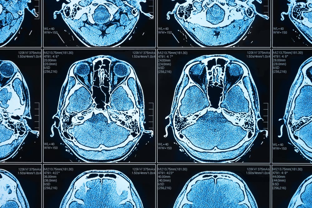Multimodal 3D Brain Tumor Segmentation with Azure ML and MONAI | by ...