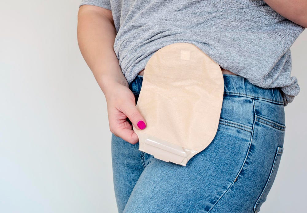 How to Care for an Ostomy at Home | by Safe n Simple | Jun, 2024 | Medium