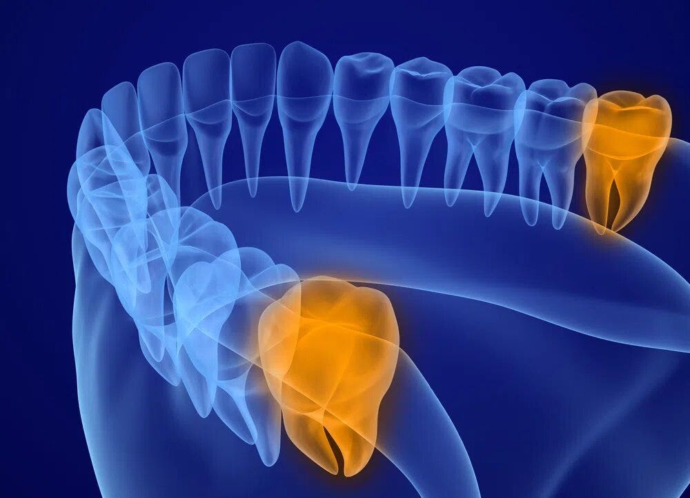 What Makes Root Canal Treatment on a Wisdom Tooth Different? | by ...