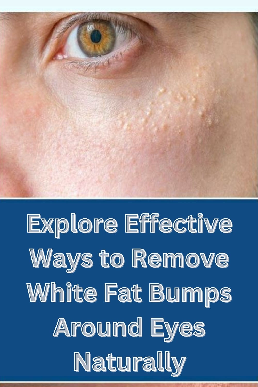 How To Get Rid of White Fat Bumps Around Eyes Naturally - Victoriakeat ...