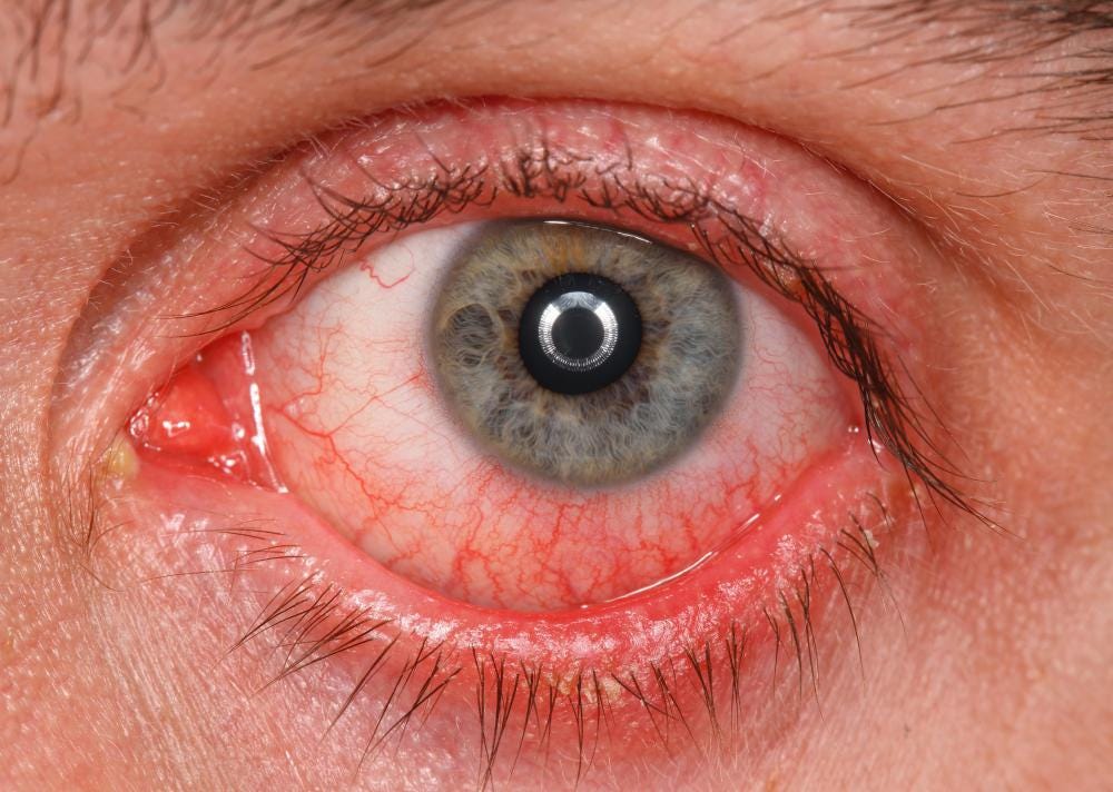 High Eye Pressure Symptoms And Treatment By Bharti Eye Foundation High Eye Pressure Symptoms And Treatment By Bharti Eye Foundation