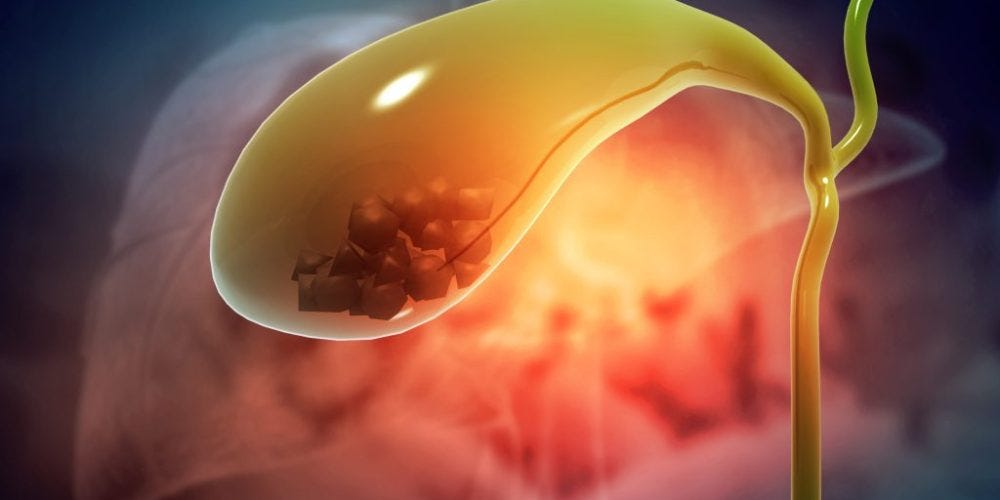 Understanding Gall Stones: A Simple Guide by Hyderabad’s Top ...