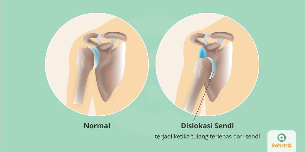 3 Penanganan Pertama Dislokasi Sendi | by Sehat Q — Asisten Kesehatan ...