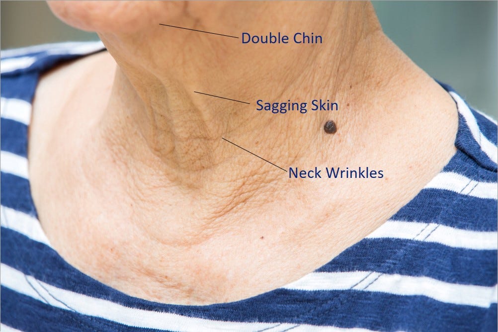 Best Non-Invasive Anti-Aging Treatment for the Neck — RF Microneedling ...