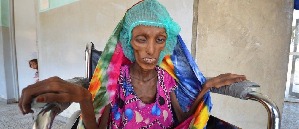 This Picture Of A Starving Girl Shocked The World But Its Just Another Tragedy In Yemens