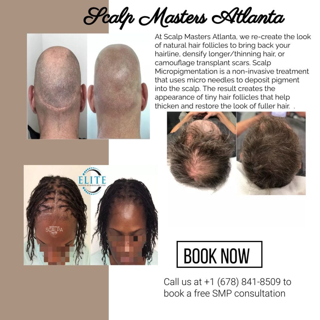 Types Of Hair Loss Scalp Micropigmentation Scalp Masters Atlanta Can ...