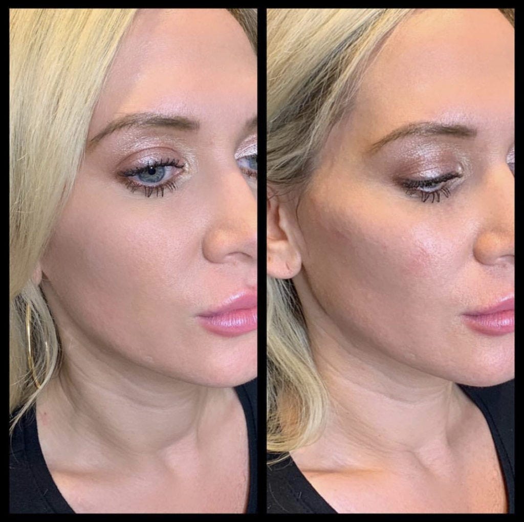 Cheek Fillers: Sculpting Your Features for a Natural Volume Boost | by ...