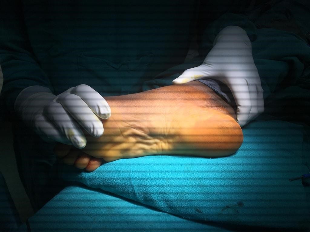 A rare case of bilateral plantar fibromatosis (Ledderhose’s disease): A ...