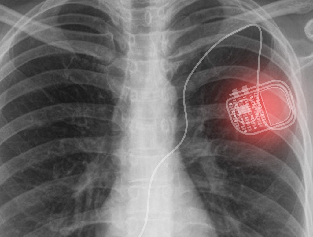 What is the Difference Between Pacemakers and Defibrillators? | by Nora ...