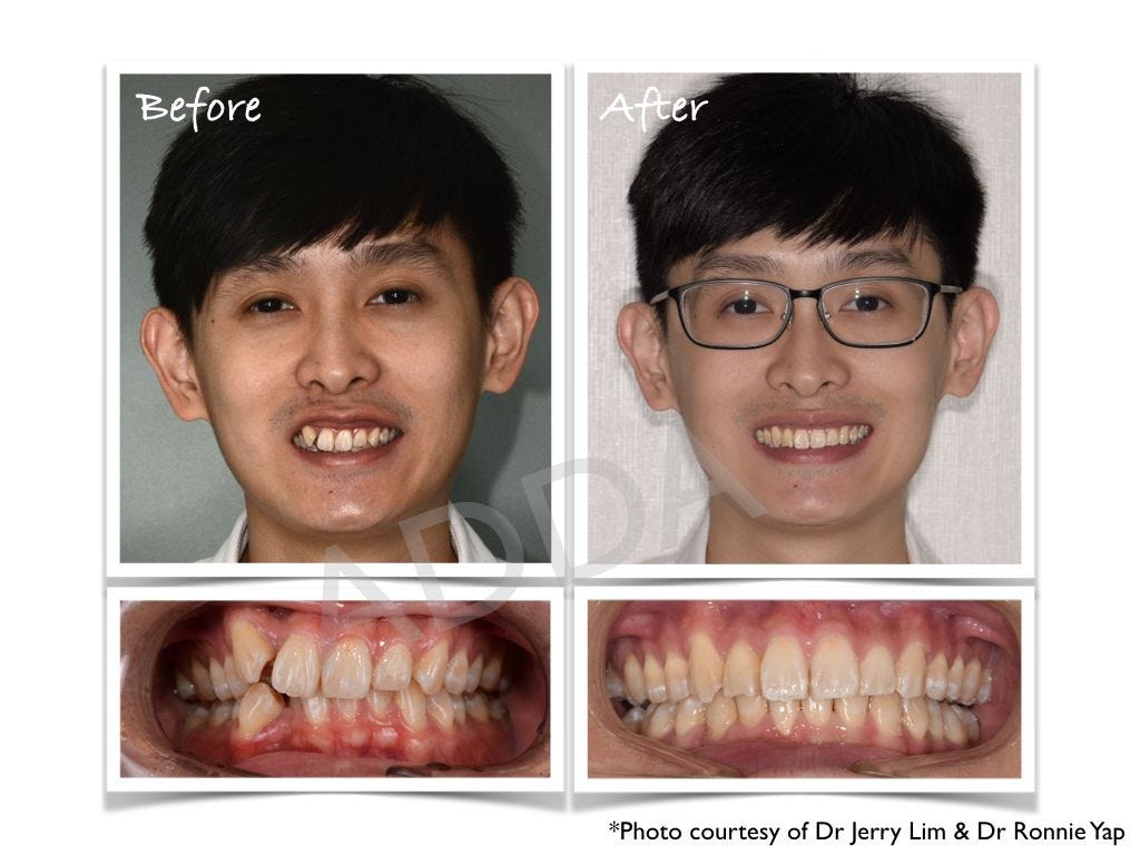 Invisalign Before and After Case Study 9 | by Aesthetic and Digital ...