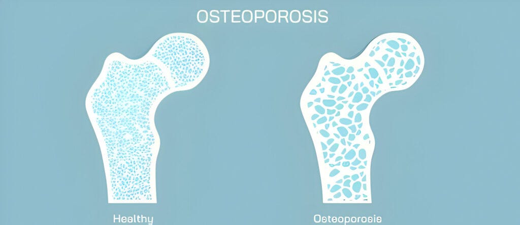 Osteoporosis and Osteomalacia: Must-Read for Better Bone Health | by ...