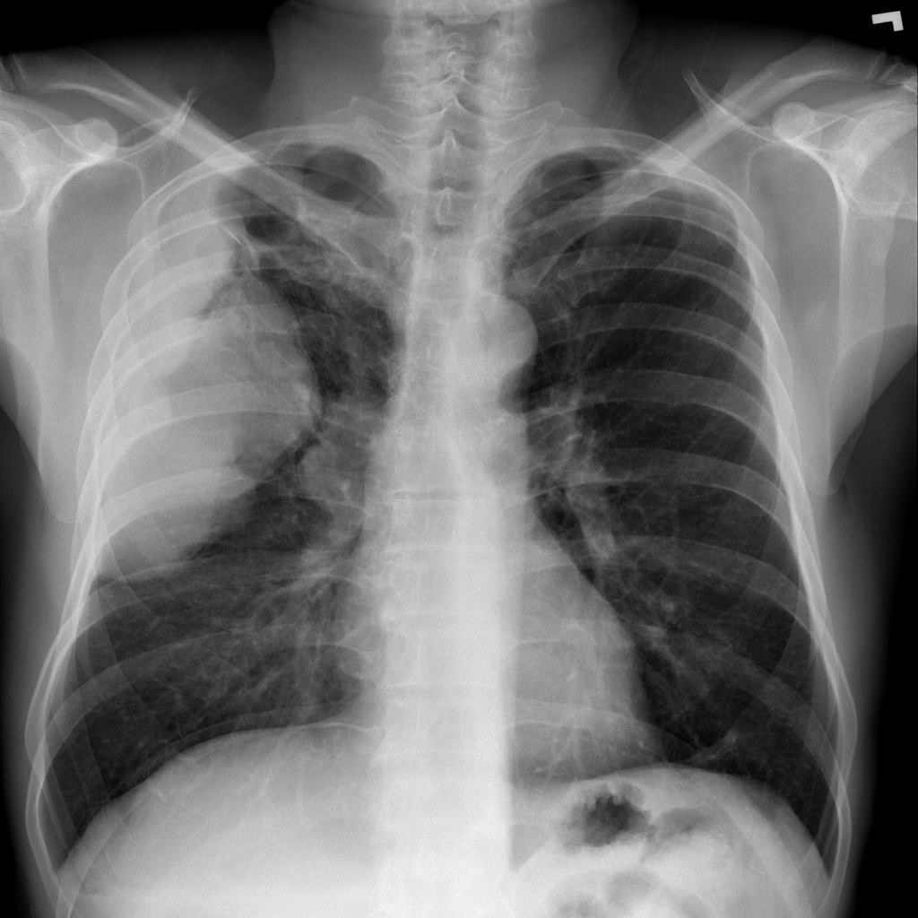 COVID 19 Prediction using Chest X-Ray Scans | by Rishit Toteja ...
