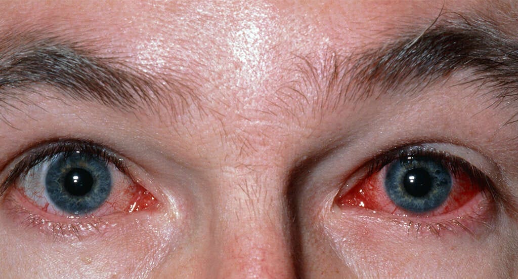 What You Need To Know About Common Eye Problems According To Dr Zuhal