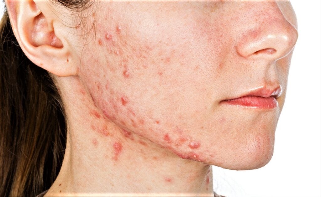 How to Treat Hormone Acne, According to Dermatologists | by Imdkawsar ...
