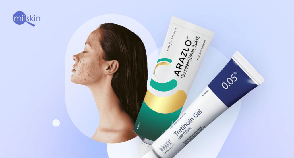 Cracking the Code: Acne Treatment Options Explained | by shopsavy365 ...