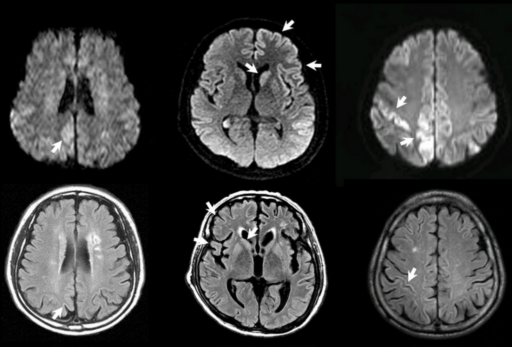 A New Hope for Prion Disease Diagnosis | by NU Sci Staff | NU Sci | Medium