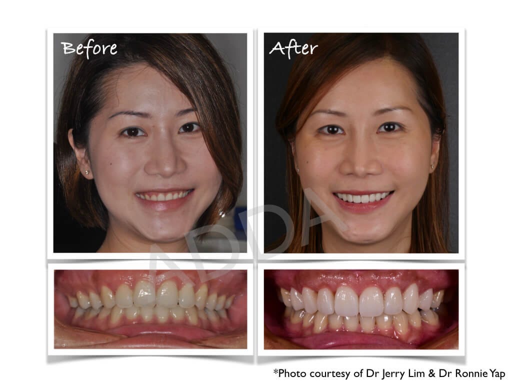 Smile Makeover Case Study 9 Before After | by Aesthetic and Digital ...