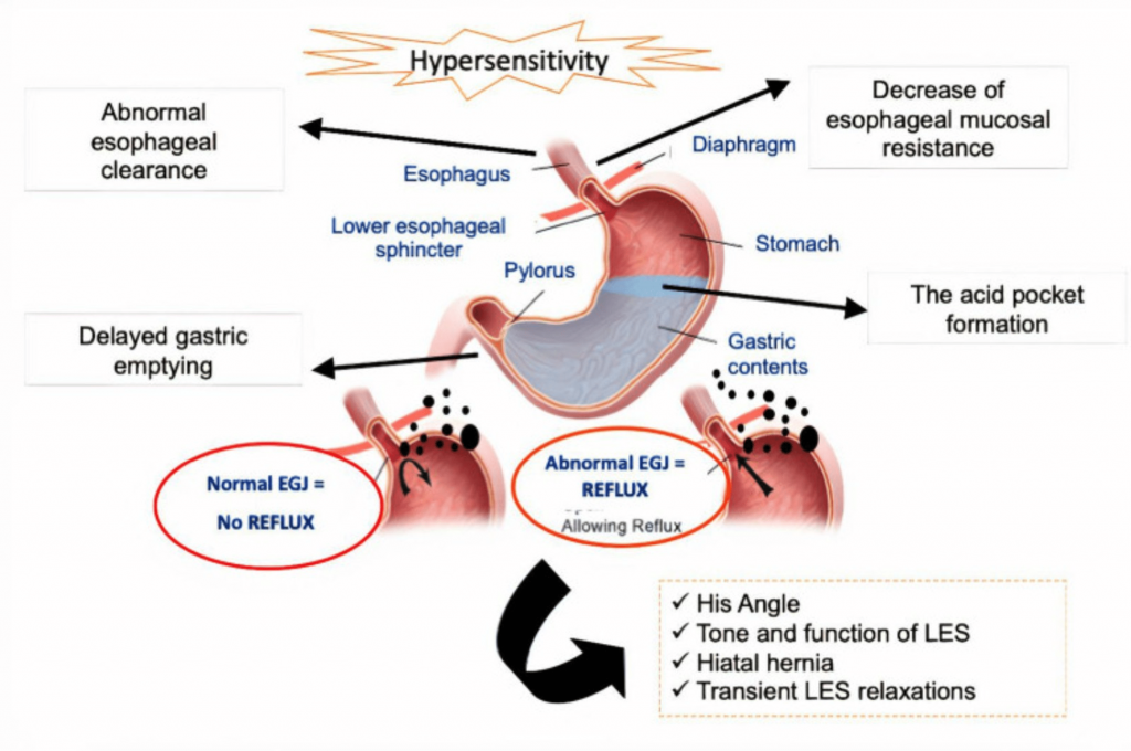 Gene Therapy for Reflux Disease in the Esophagus | by Scot Thom | Medium