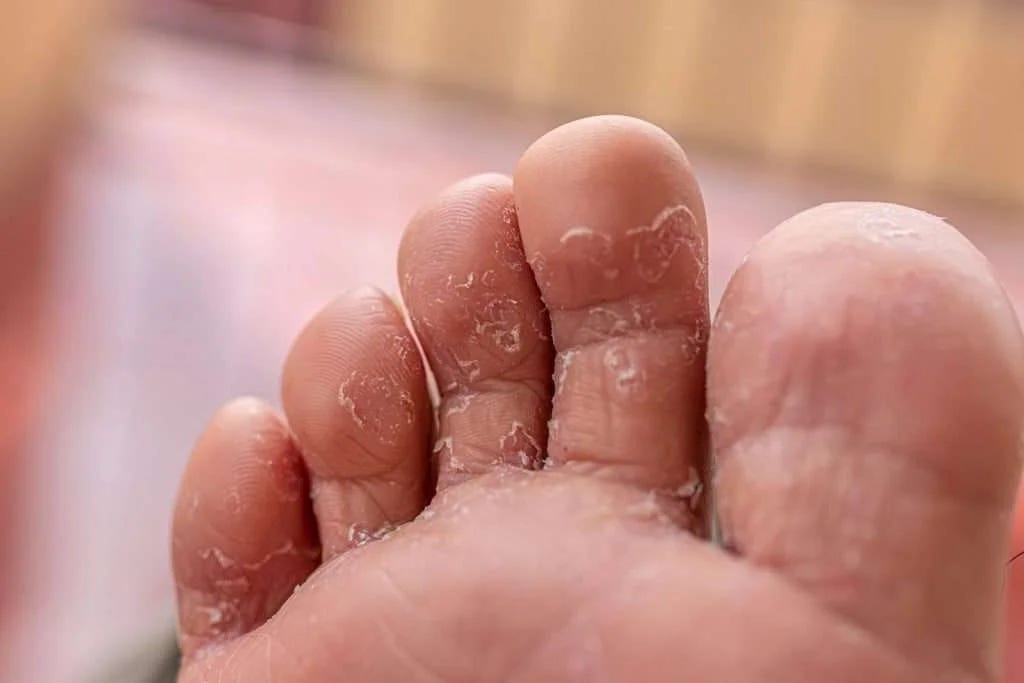 Comprehensive Overview of The Tinea Pedis Treatment Market Along with Emerging Trends ...
