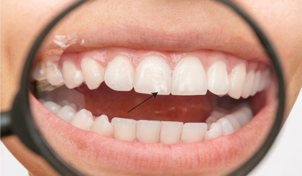 When to see a dentist about white spots on your child’s teeth | by ...