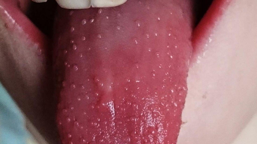 What Causes Small Red Patches On Tongue By Kelon Nyanguno Medium