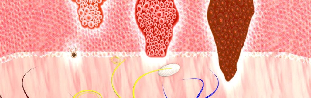 Melanin — a protector from skin cancer | by Research Outreach | Medium
