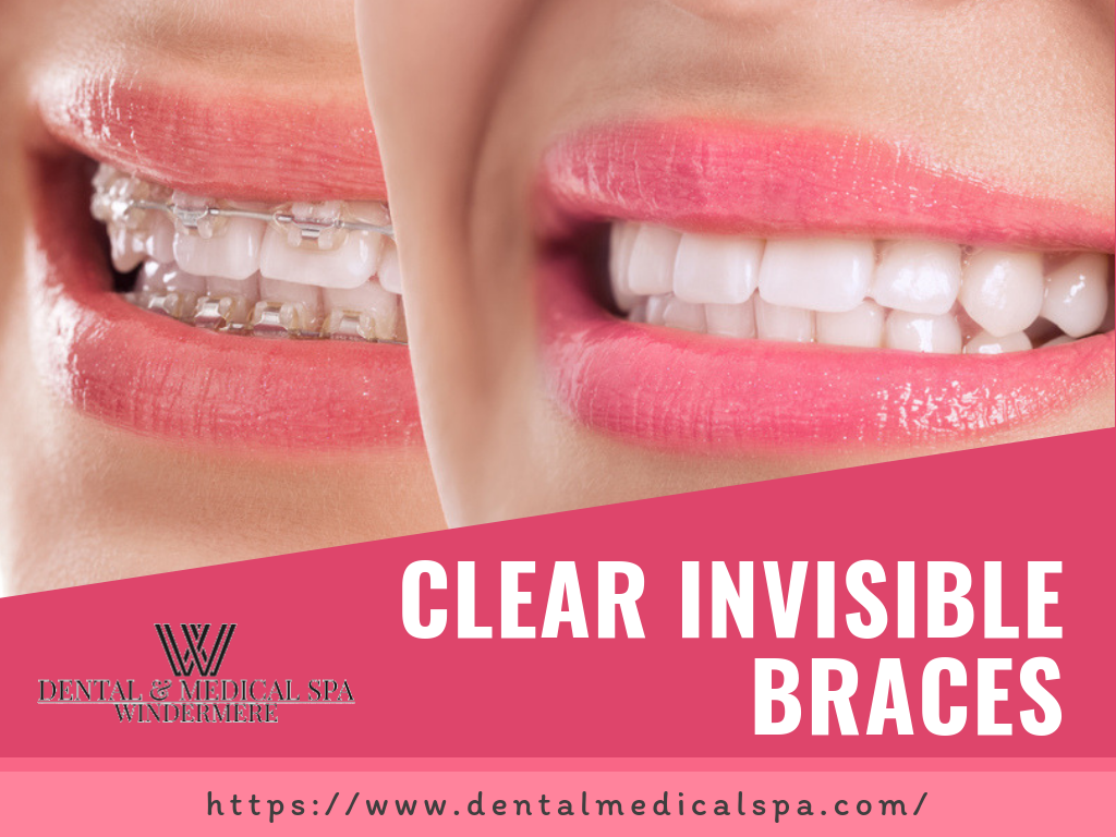 Metal Free Invisalign Treatment. Are you facing problem with metal ...