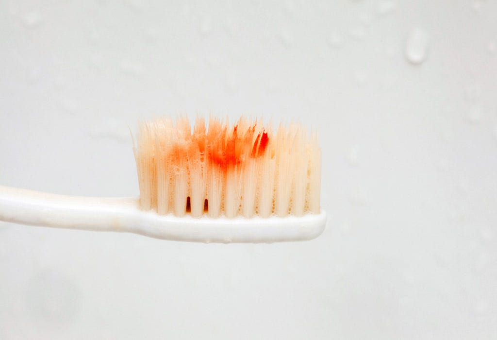 Gum Bleeding — Blood From Teeth Home Remedies - Fanirathod - Medium