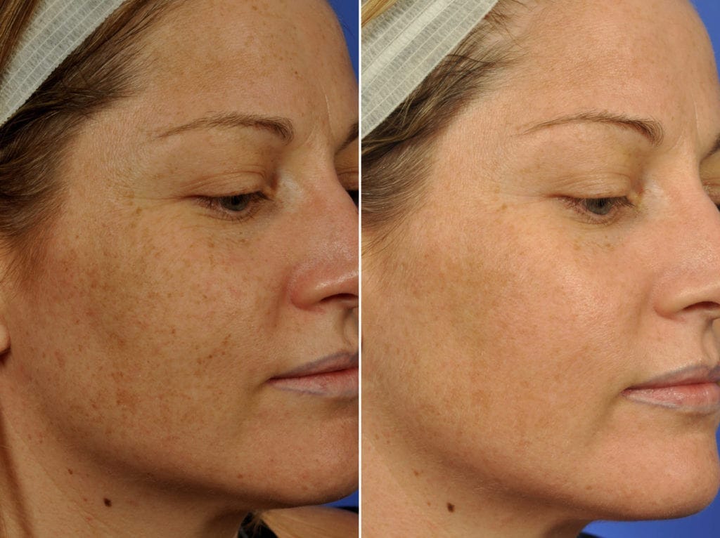 Mesmerize Everyone With Clear and Brilliant Laser Facial Coral Springs ...