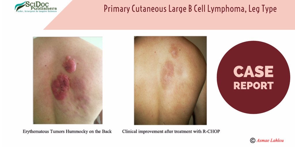case report — Primary Cutaneous Large B Cell Lymphoma, Leg Type | by SciDoc Publishers | Medium