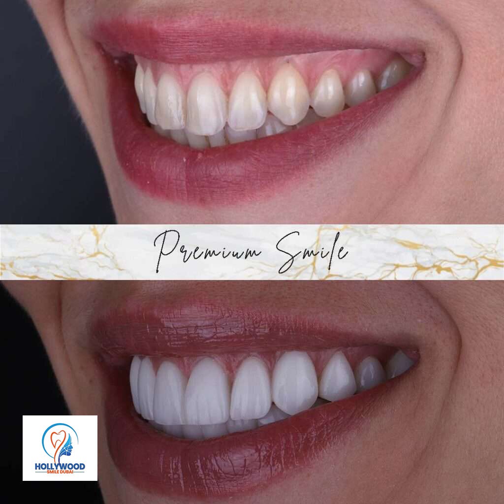 Premium Smile Hollywood. - Hollywood Smile - Medium