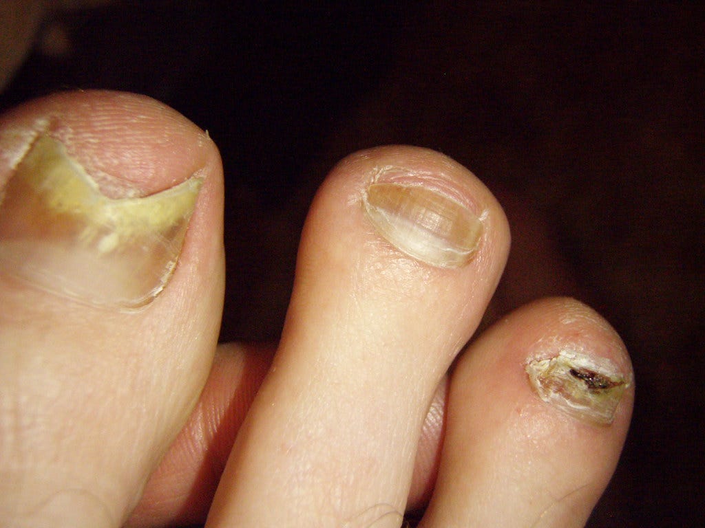 Unlocking the Secrets of Yellow Toenail Causes and Treatment | by ...