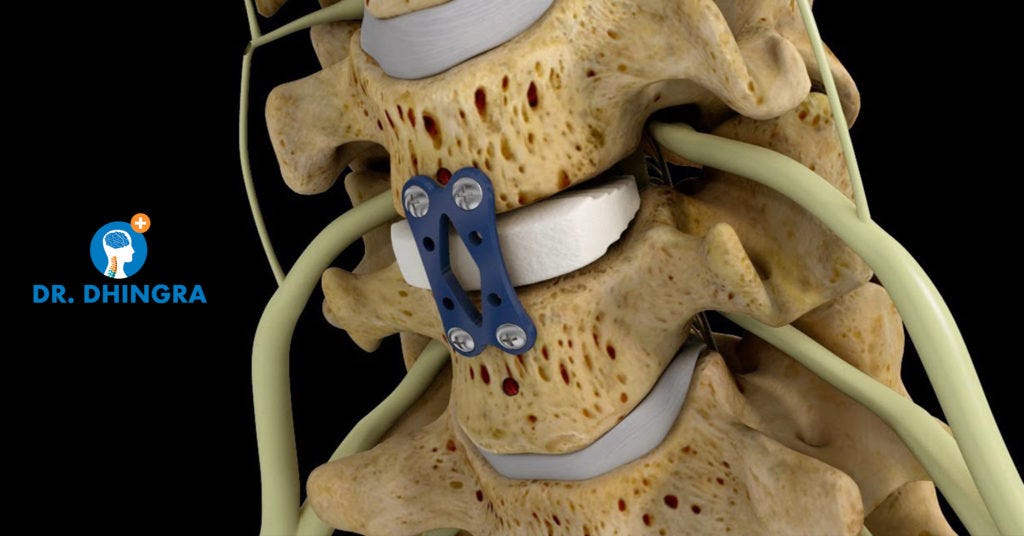 CERVICAL FUSION — CAUSES AND TYPES OF THE PROCEDURE | by Dr Anil ...