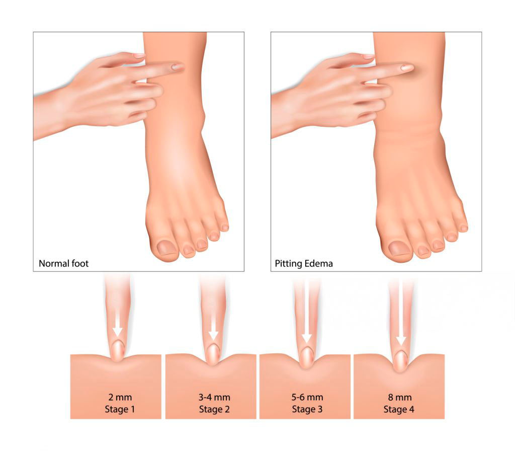 How Fluid Retention Works in the Human Body | by Fabienne | Feb, 2025 ...