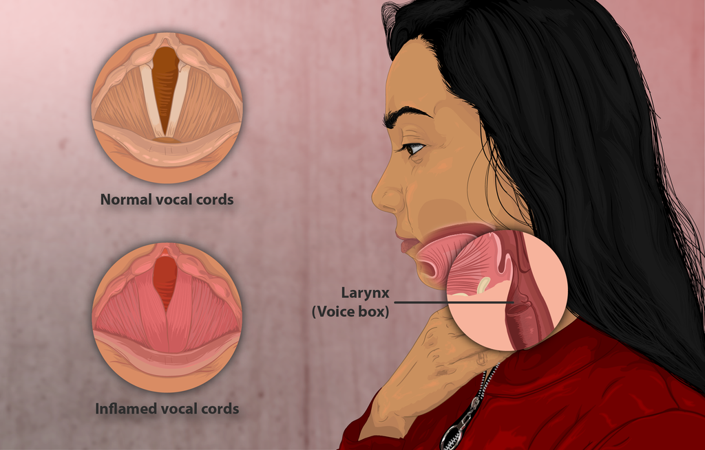 My Yearlong Hoarse Voice Was Caused By Acid Reflux By Lynn L